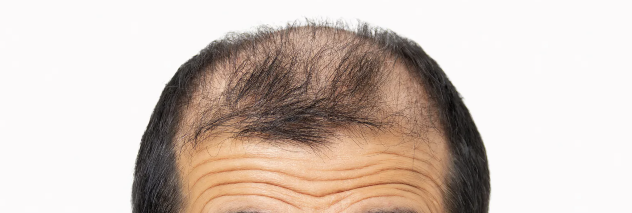 Male Pattern Hair Loss - Hair Restoration Doctors